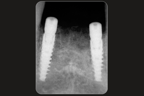 Implants auto-forants Nobel Active