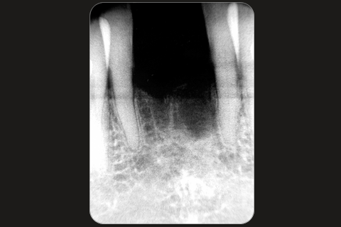 Implants auto-forants Nobel Active