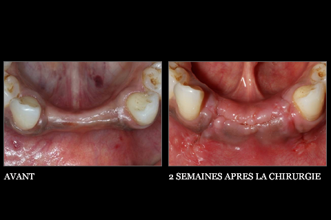 Greffe osseuse. Piezo chirurgie